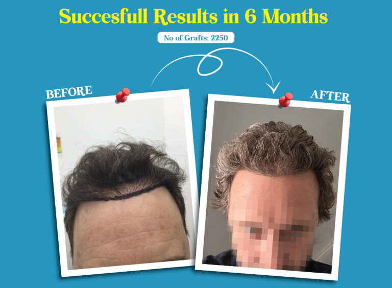 Male Hair Regrowth Package – Restore Your Confidence at My Cosmetics ...