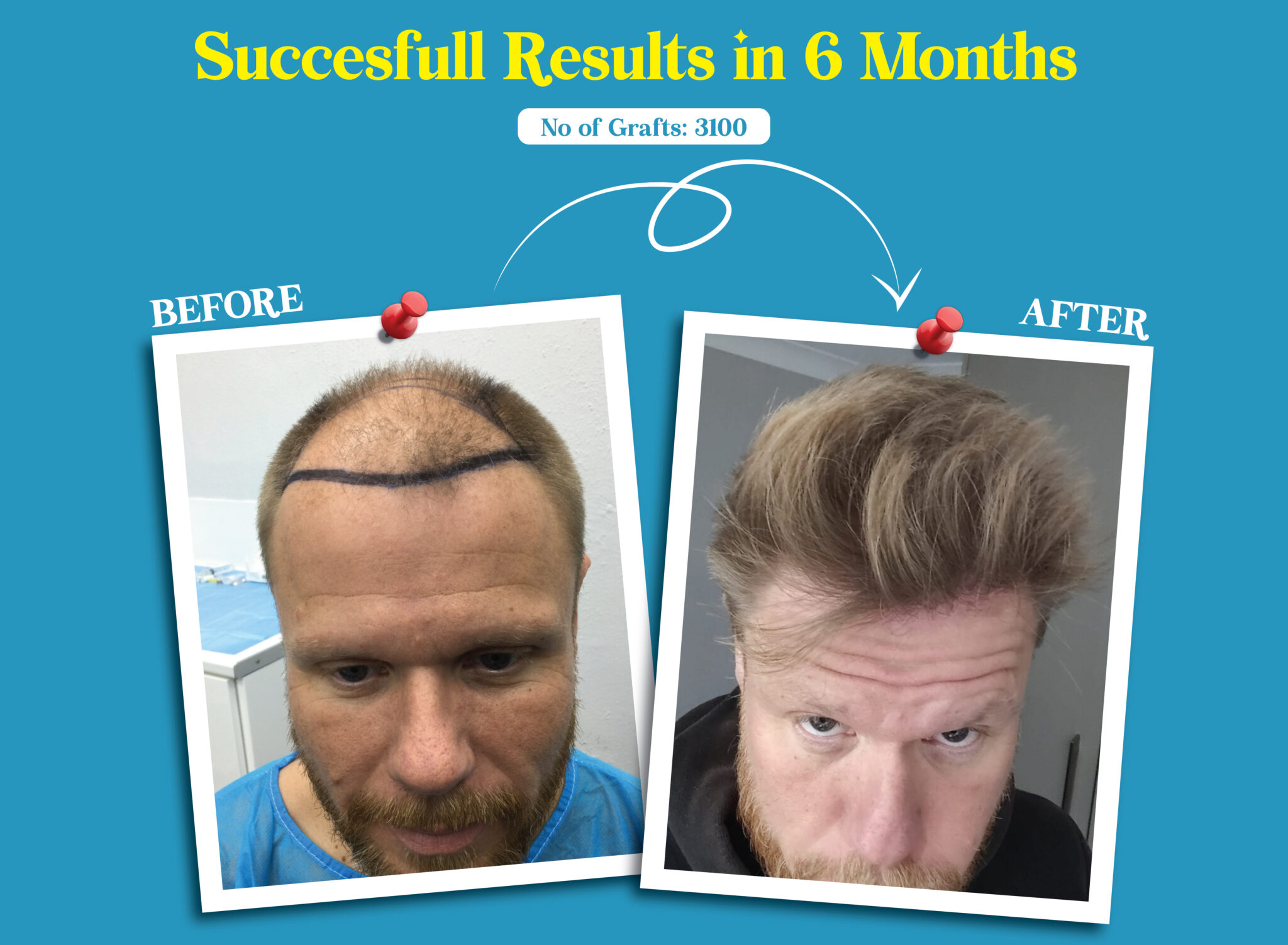 Top Hair Treatment for Men: Restore Your Confidence Today - My Cosmetic ...